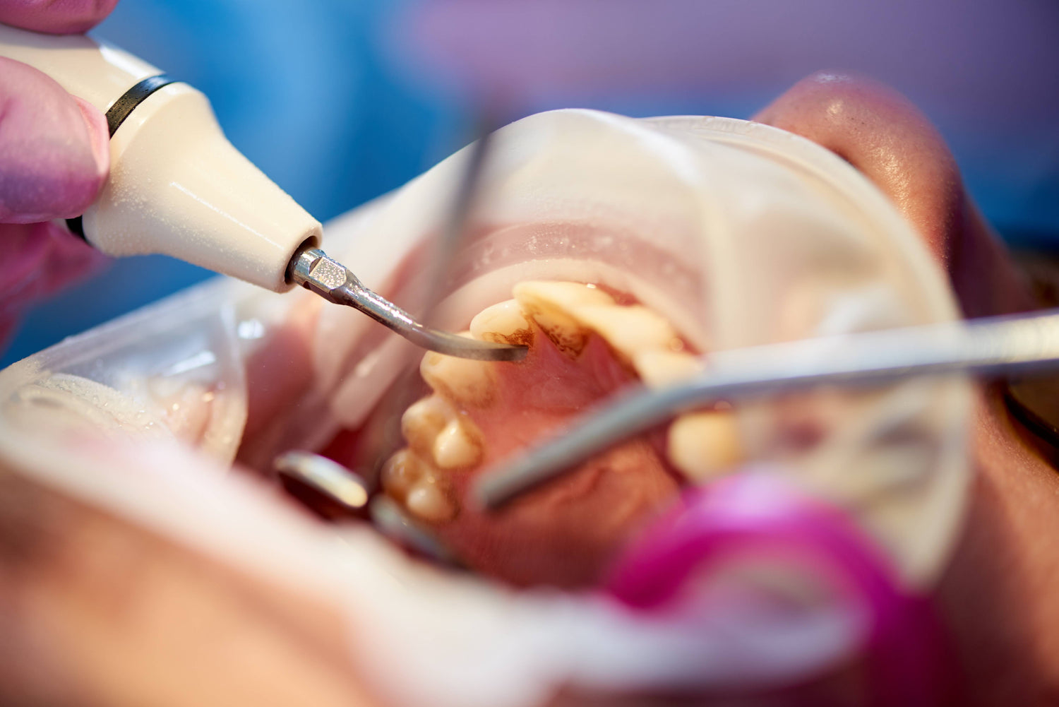 Détartrage Profond : Les Etapes Essentielles De Cette Procédure ...