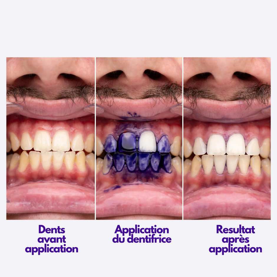 Plaque Dentaire : Qu'est-ce que c'est et comment la traiter ? – Dentica